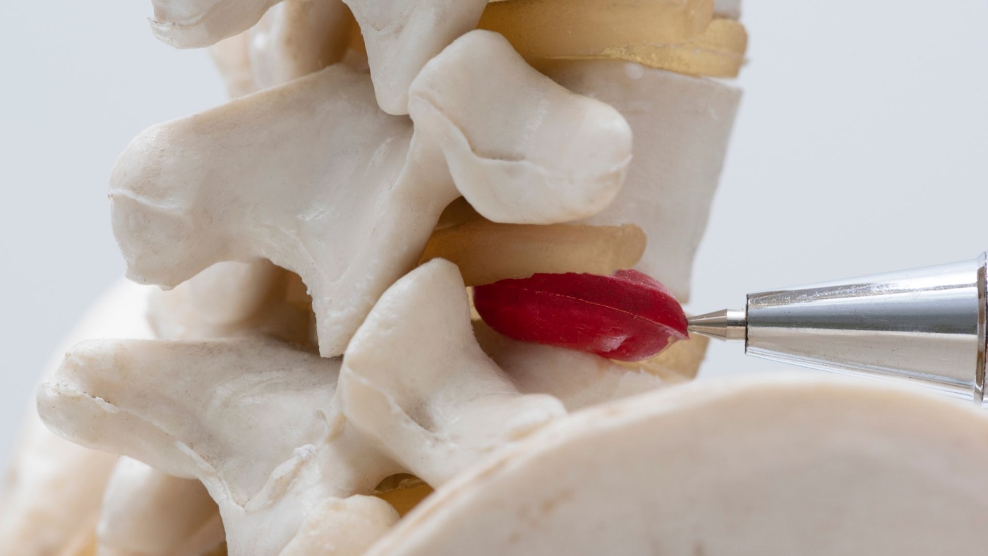 Αρθροπλαστική δίσκου